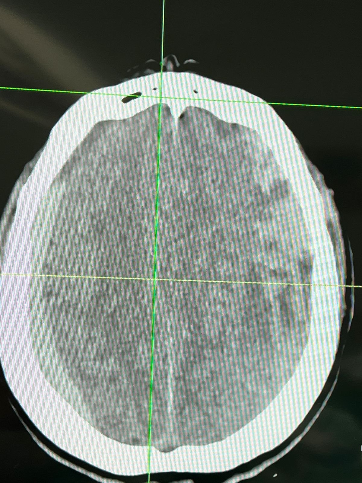 Cirugias Realizadas - NeuroZone 3D